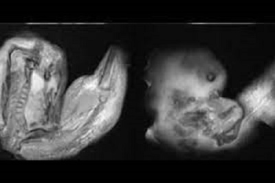 Apa Itu Kembar Parasit? Tak Cuma Janin Tumbuh di Otak Bayi Shanghai