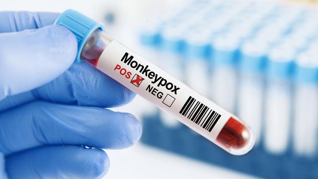 Ciri Khas Ruam Cacar Monyet, Ini Bedanya dengan Alergi